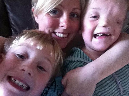 British boy born with half face - Global Times