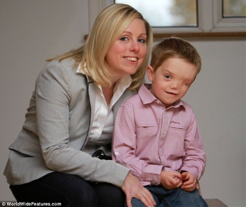 British boy born with half face - Global Times