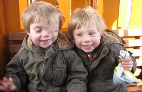 British boy born with half face - Global Times