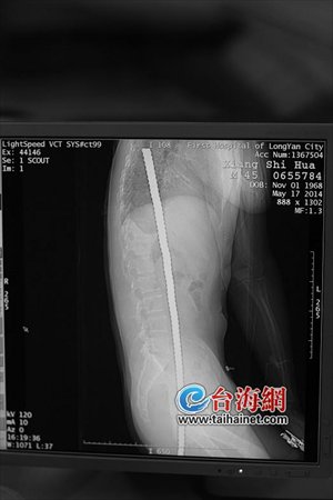 Worker impaled by falling rebar, miraculously survives - Global Times