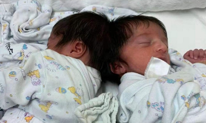 Israeli hospital separates head-connected baby twins in rare operation ...