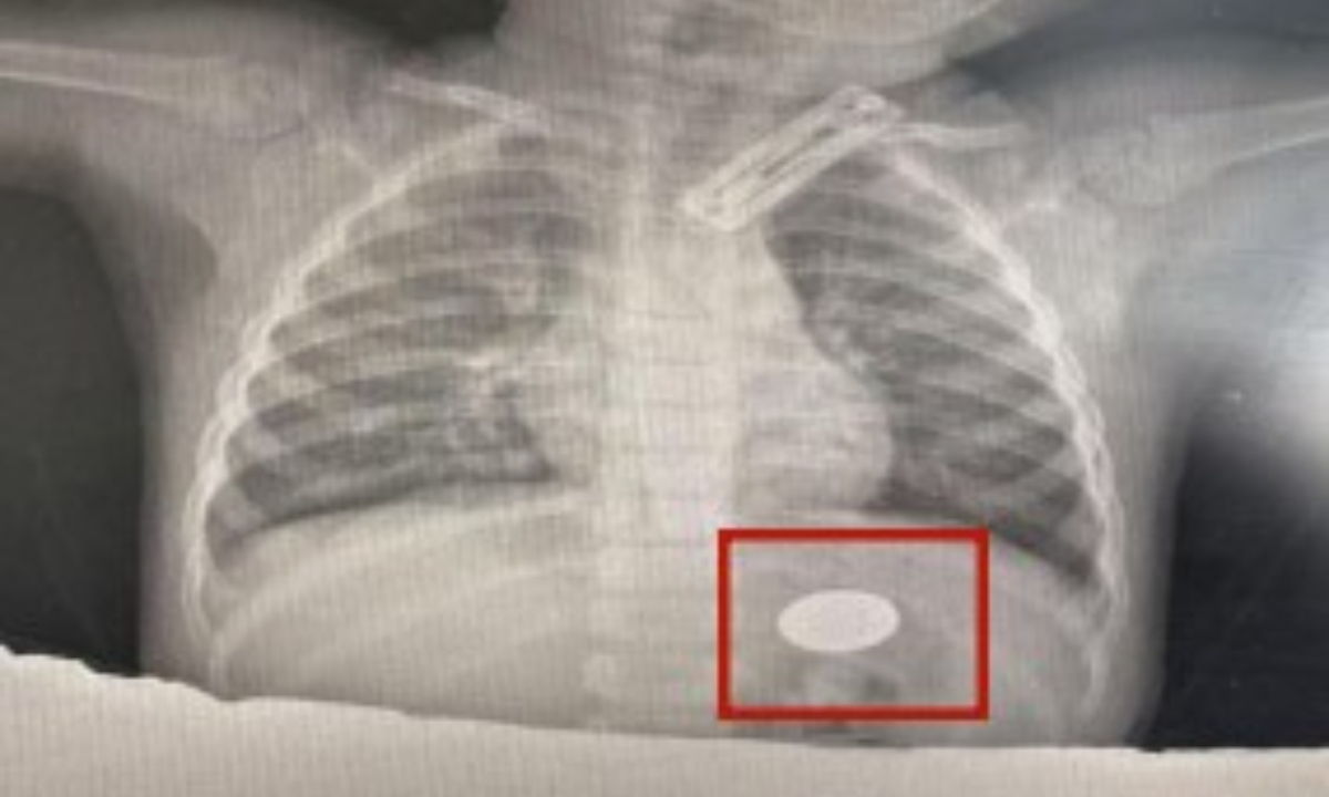 Child's chest X-ray accidentally reveals a coin in stomach that had ...